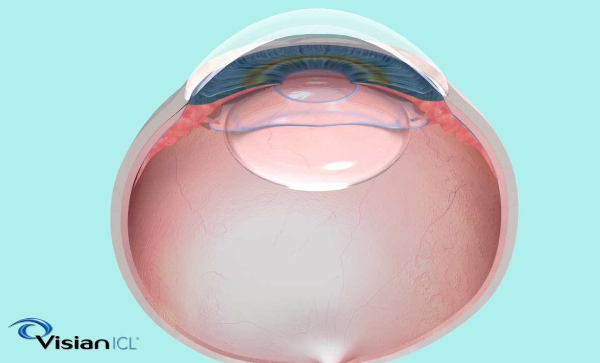 Not a LASIK candidate? Severely Nearsighted? Call us! Personal patient ...